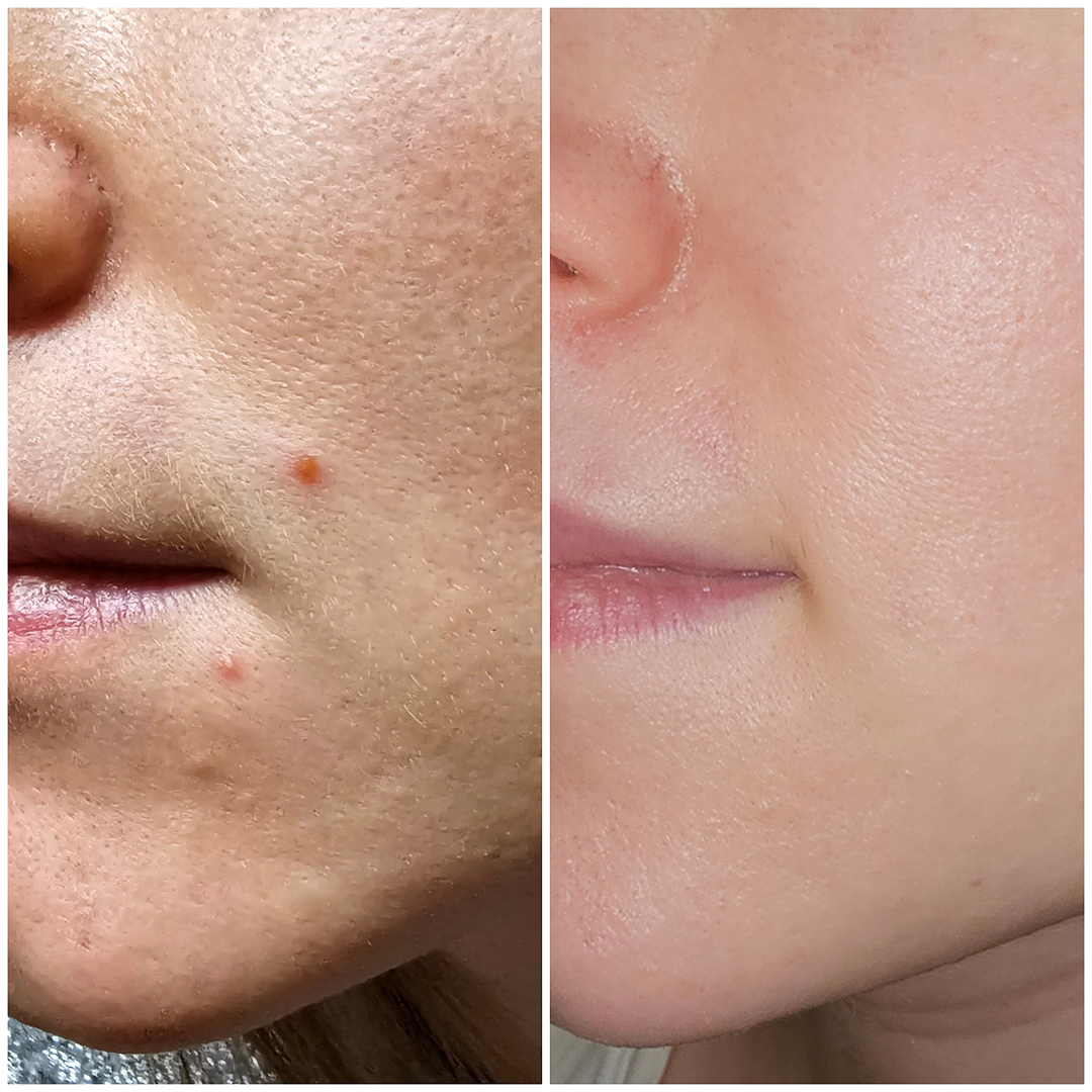 NYC Acne Treatment Center removes treat acne Blackheads Papules ...