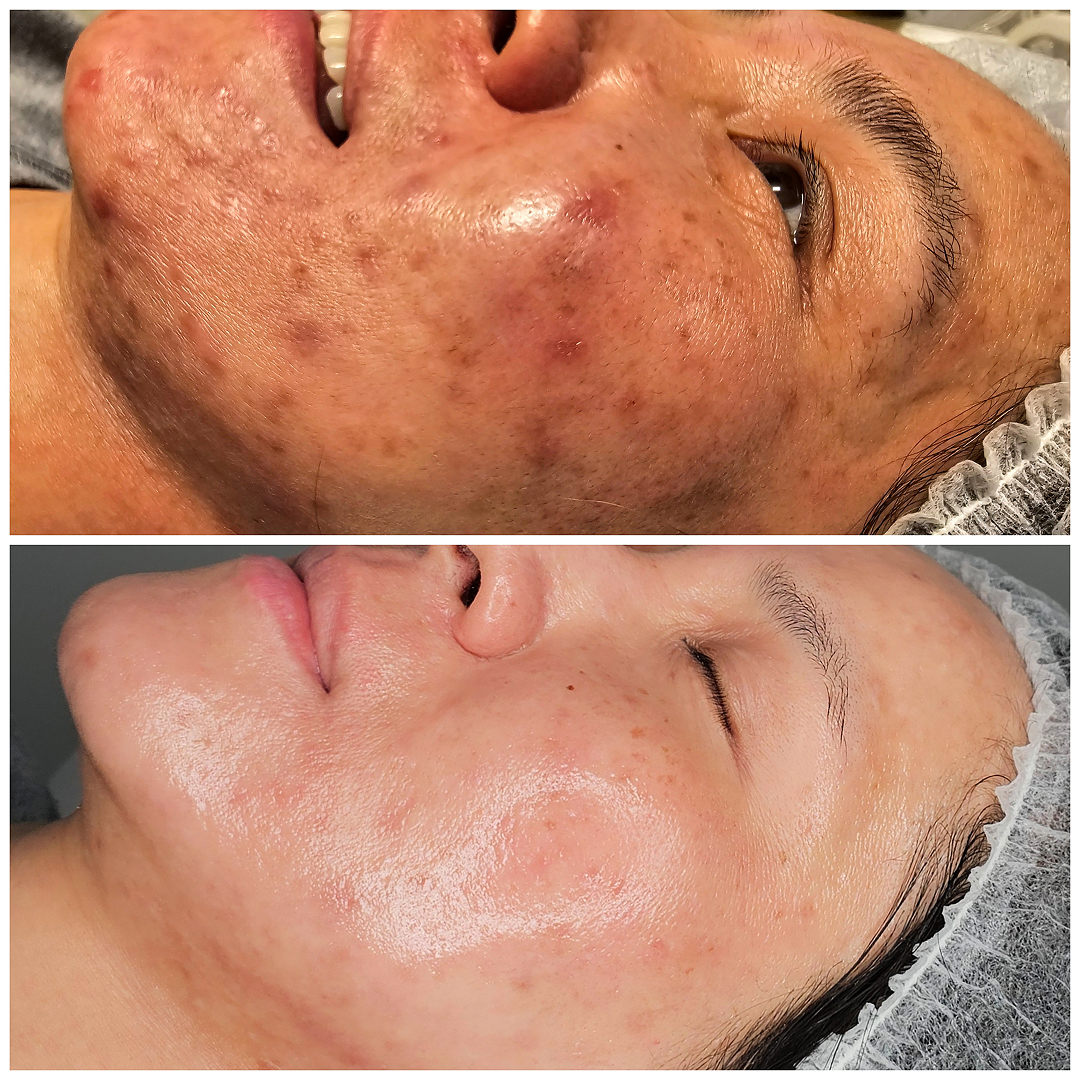 NYC Acne Treatment Center removes treat acne Blackheads Papules ...