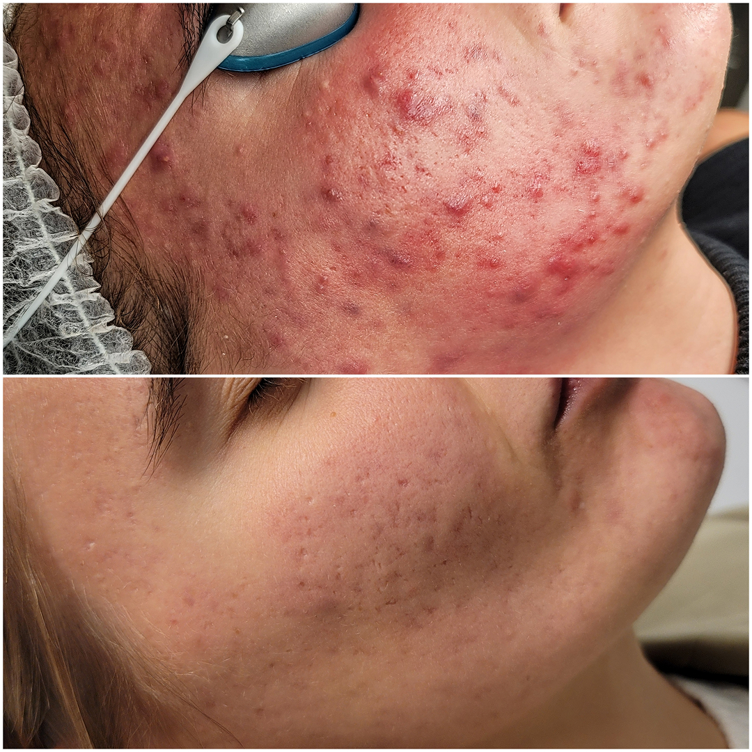 NYC Acne Treatment Center removes treat acne Blackheads Papules ...